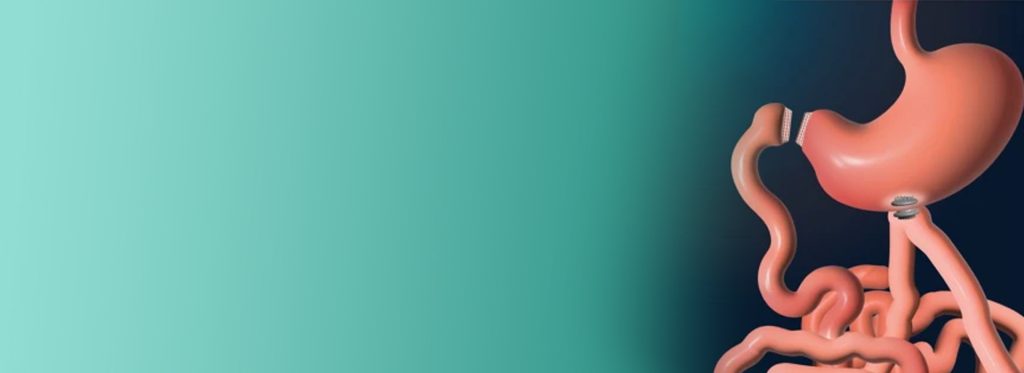 Sleeve Gastrectomy With Proximal Jejunal Bypass - Dr.Amit Garg